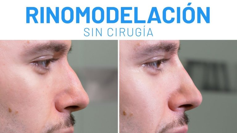 Rinomodelación con ácido hialurónico - CIO Salud