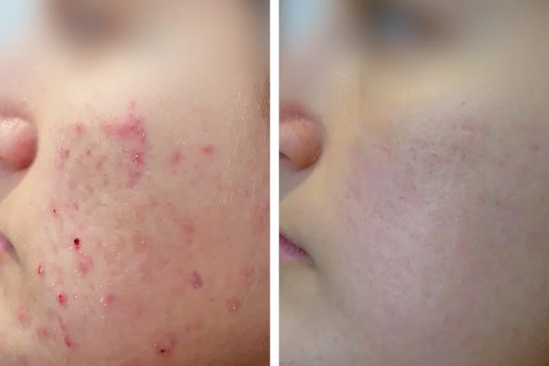 Acné juvenil, causas y tratamiento dermatológico - CIO Salud