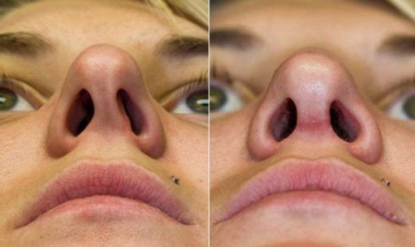 Tabique nasal desviado: Diagnóstico y tratamiento - CIO Salud