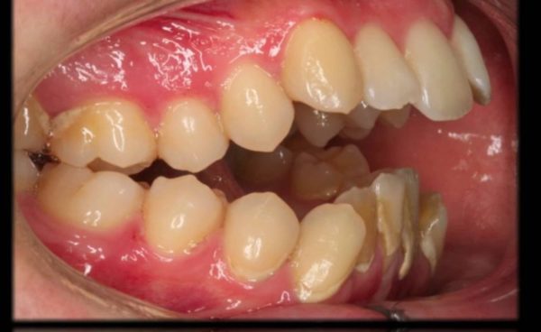 Cómo Evitar Empujar Los Dientes Con La Lengua Cio Salud