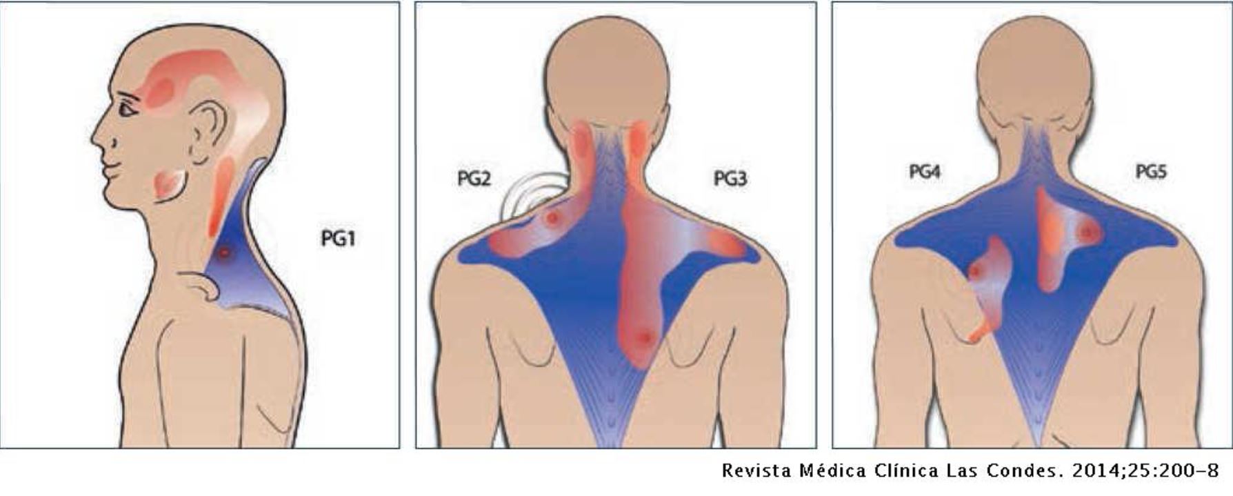Punción seca en fisioterapia, ¿qué es y para que se utiliza? - CIO Salud