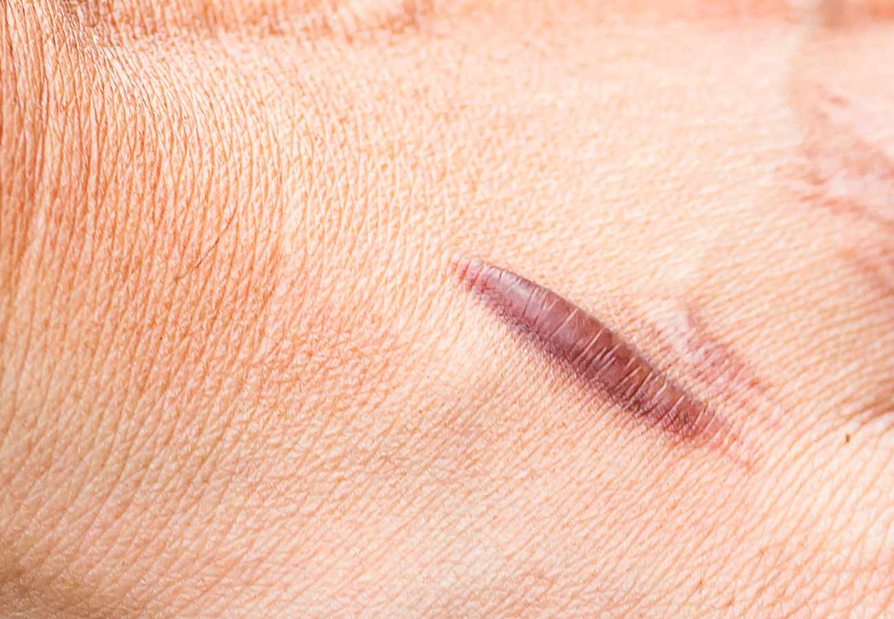 Cómo eliminar una cicatriz: Tratamientos - CIO Salud