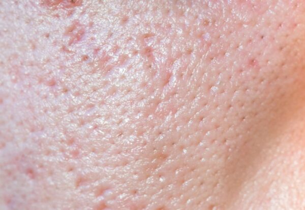 Tipos de piel, ¡identifica la tuya! - CIO Salud