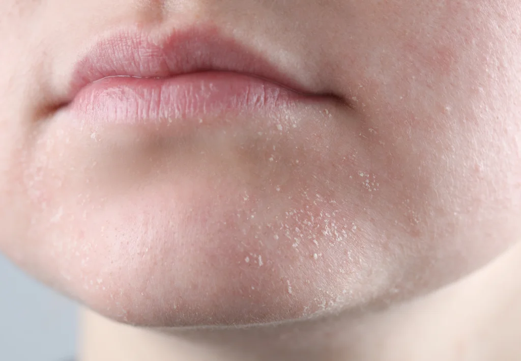 Consejos para proteger la piel en invierno - CIO Salud