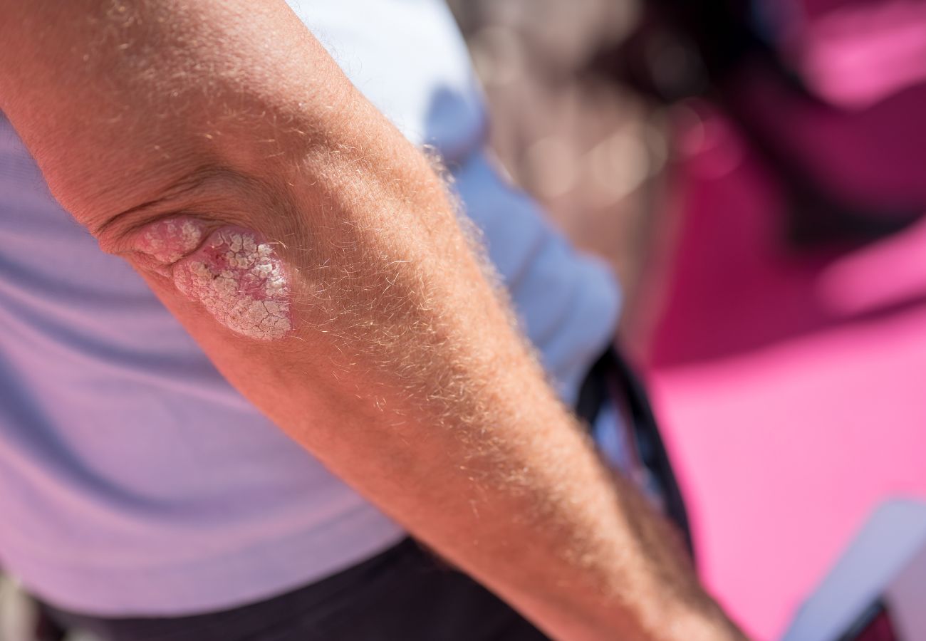 Tipos de psoriasis y cómo tratarlas - CIO Salud