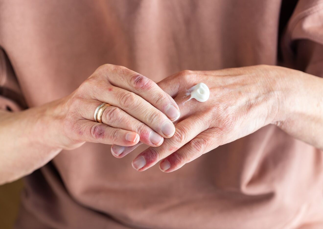 Dermatitis en las manos: cómo aliviarla - CIO Salud