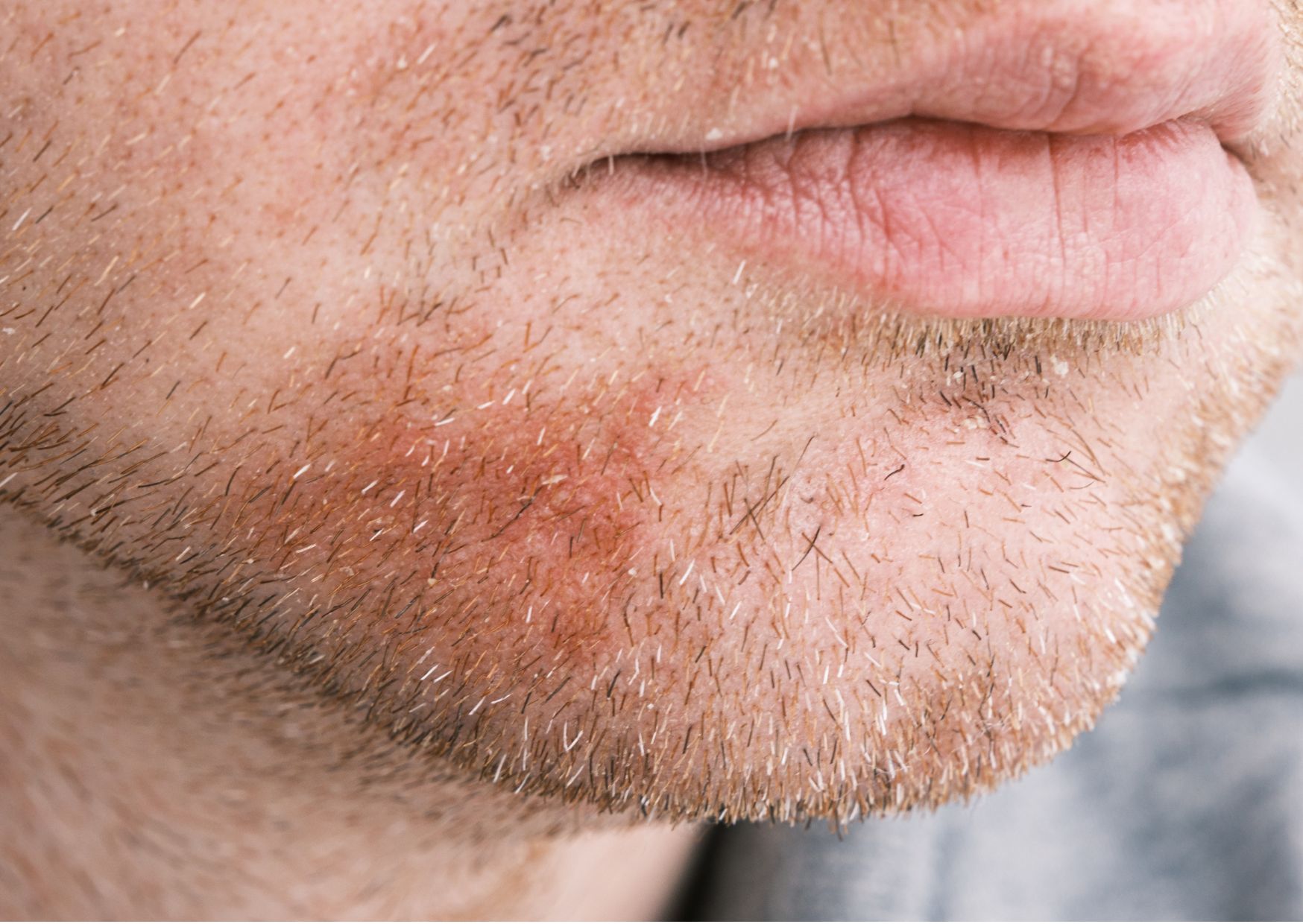 Dermatitis en la cara: causas, síntomas y soluciones - CIO Salud