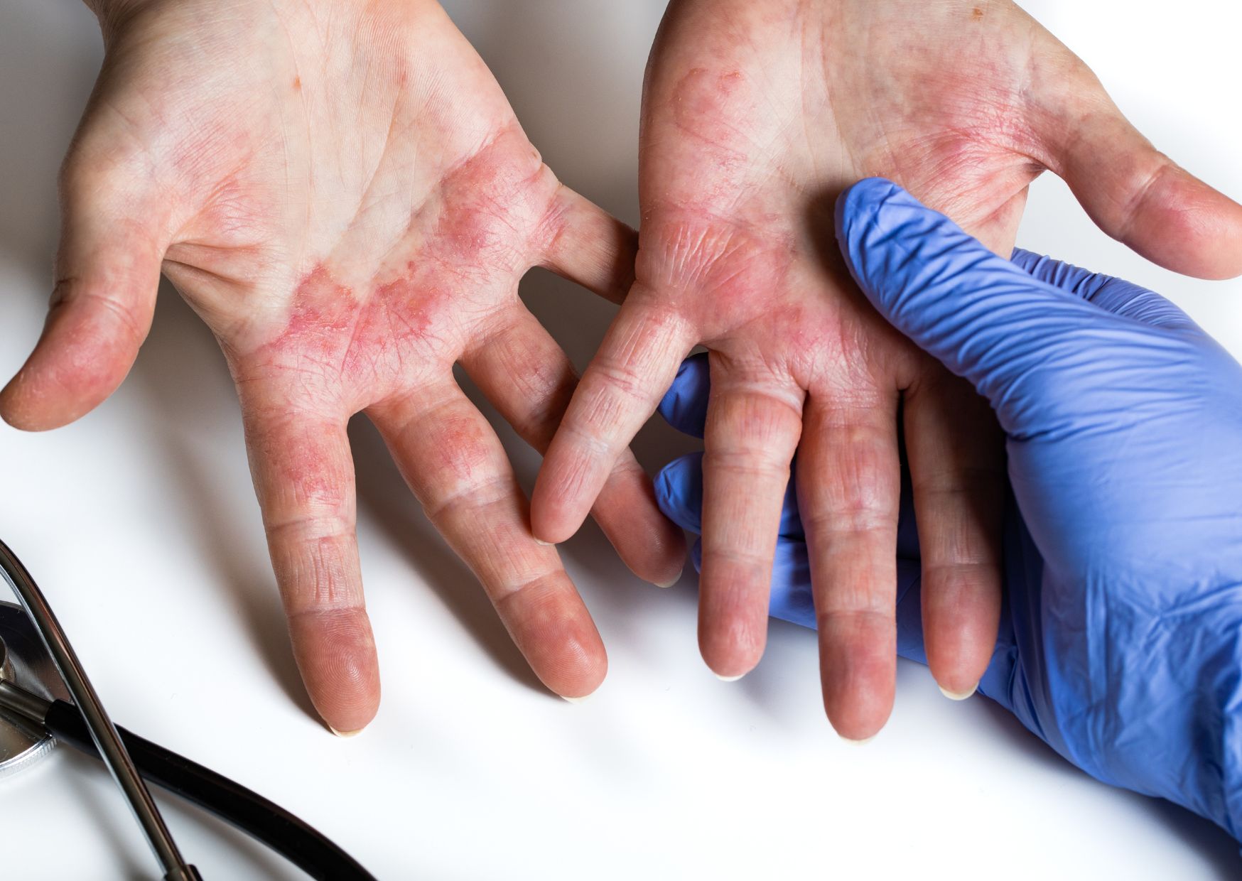 Dermatitis en las manos: cómo aliviarla - CIO Salud
