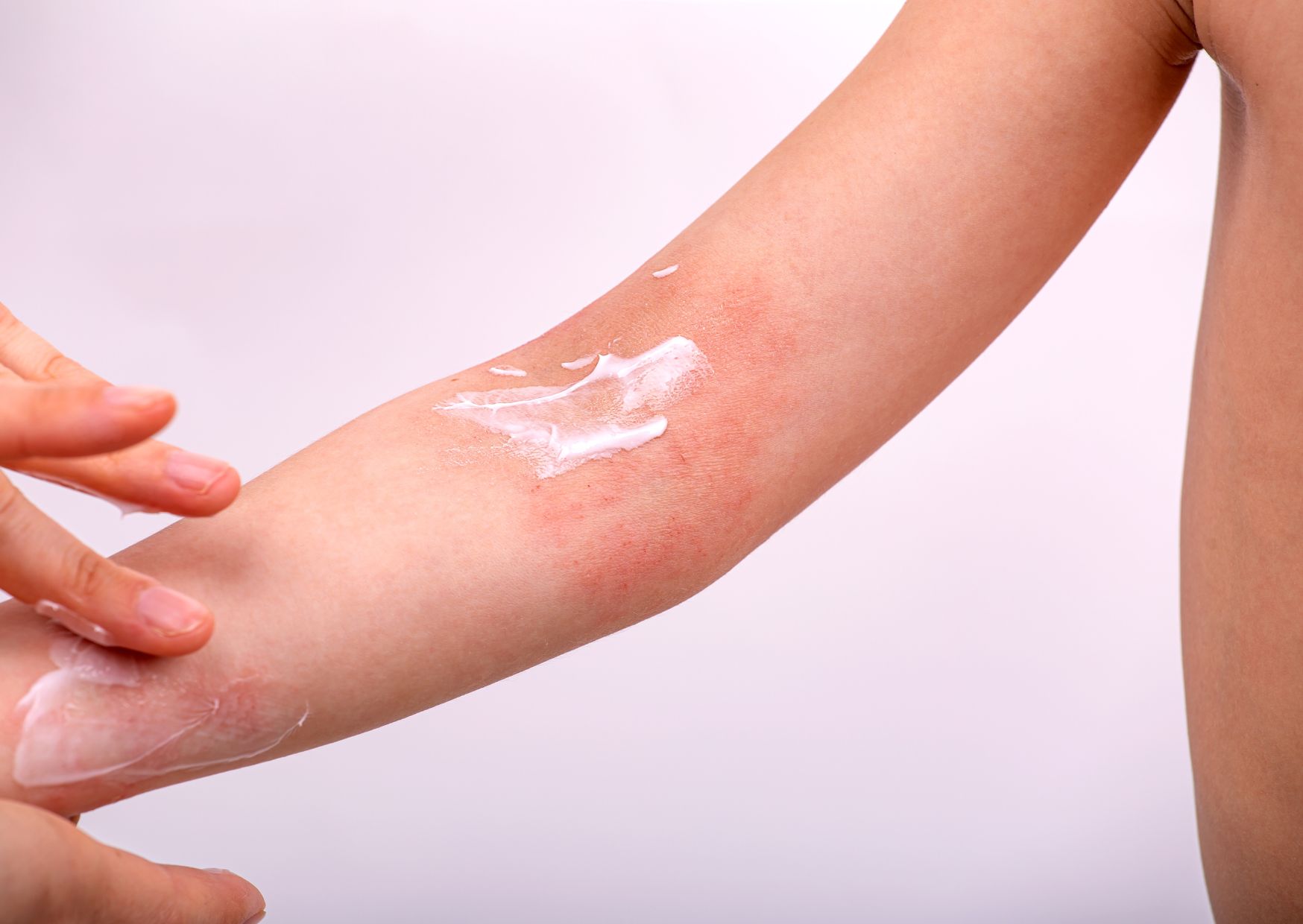 Qué es una piel atópica y cómo cuidarla a diario - CIO Salud